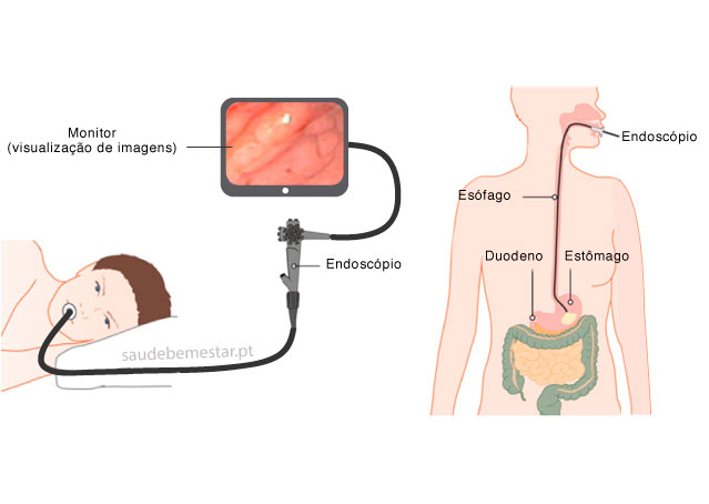 Endoscopia Digestiva Alta Passo Fundo - Endoclin Passo Fundo